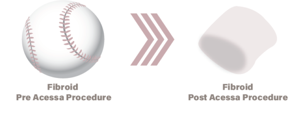 Acessa Procedure for Fibroids | Advanced Gynecology of Tampa Bay