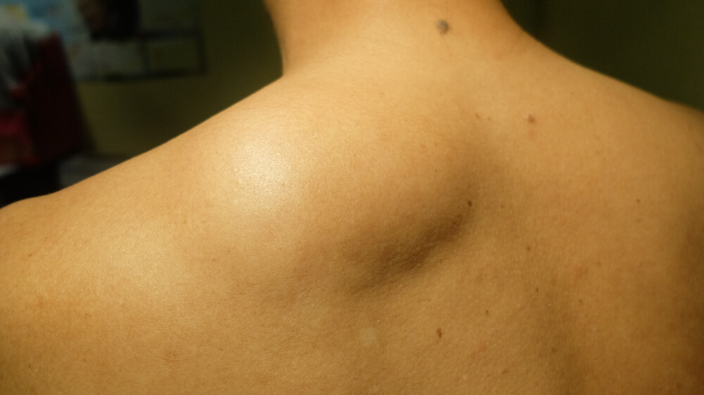 Soft Tissue Tumors 10 Important Things You Need To Know Advanced
