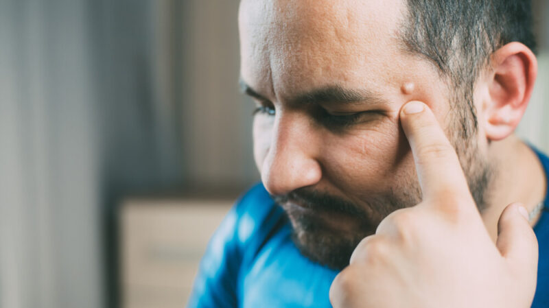 Lipoma – Treatment, Symptoms, and Diagnosis | Advanced Surgical Physicians