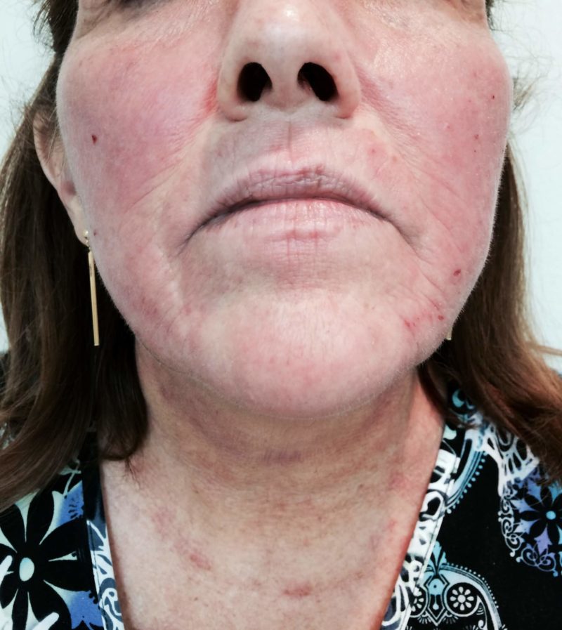 Skin Allergy Treatment In Miami, Florida | Allergy & Immunology Center