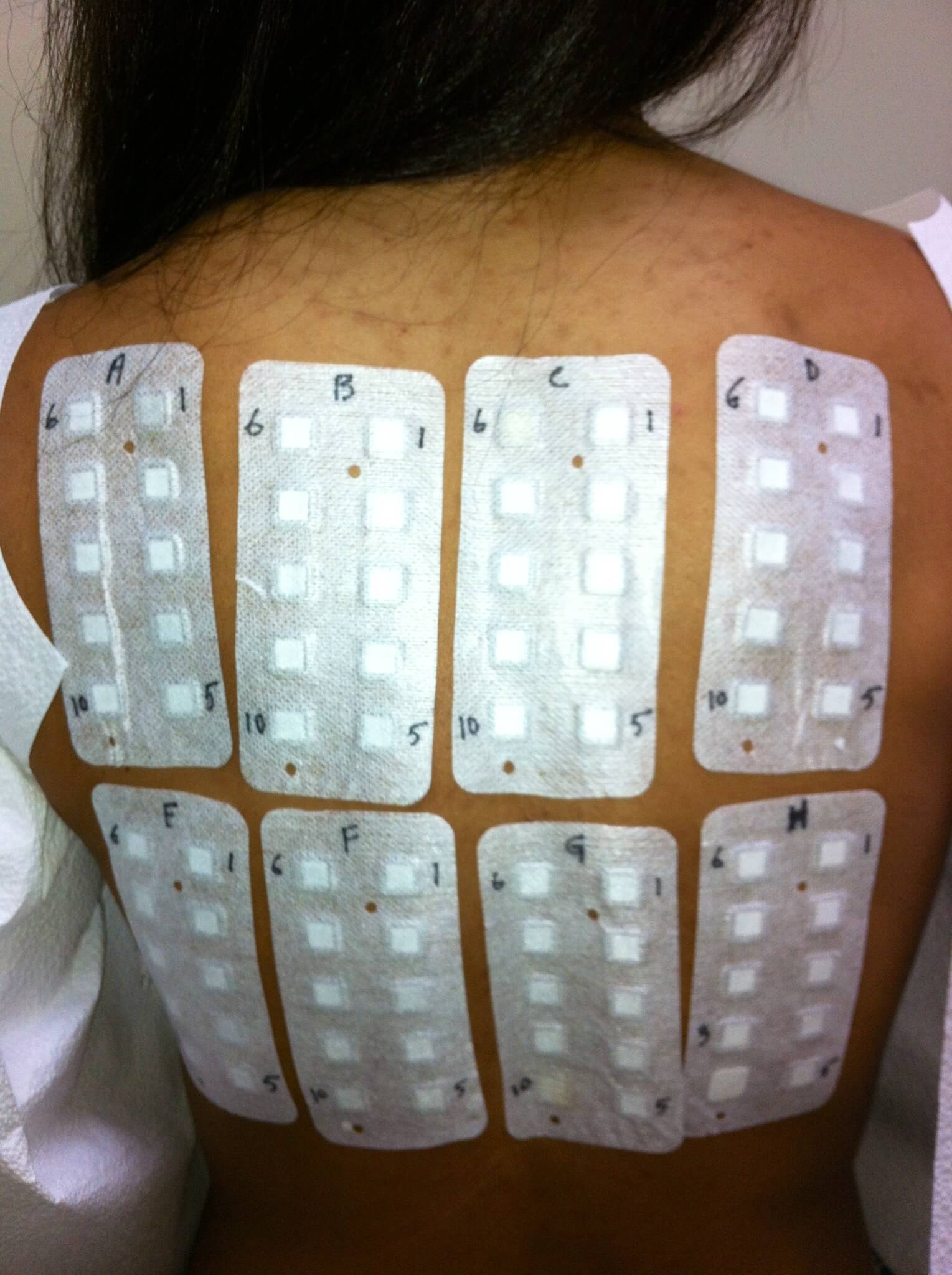 Skin Allergy Consultation In Miami, FL | Allergy & Immunology Center