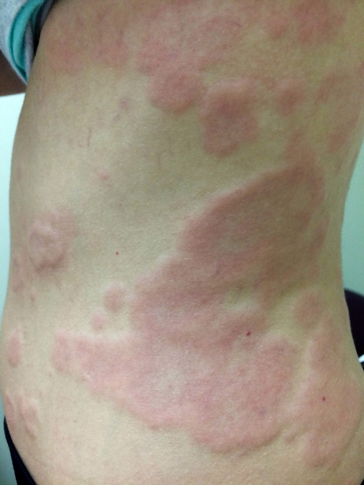 Hives/Urticaria Treatment In Miami, Florida | Allergy & Immunology Center