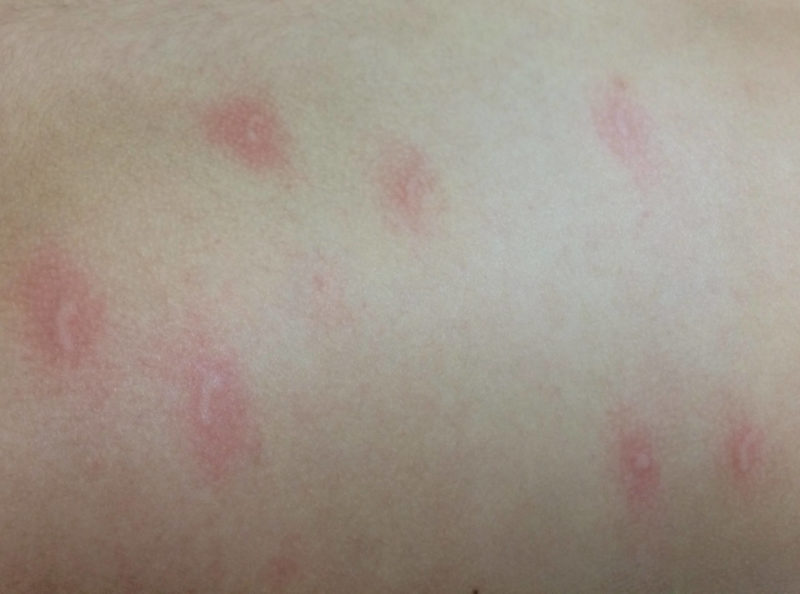 Hives/Urticaria Treatment In Miami, Florida | Allergy & Immunology Center