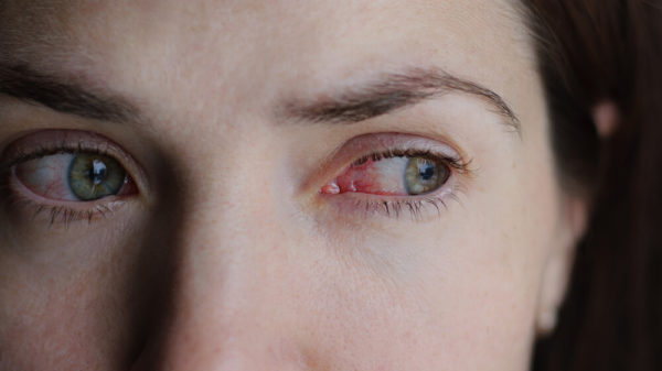 Allergic Conjunctivitis: Causes, Symptoms, and Treatment | Allergy ...