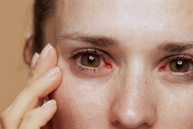 Eye Allergies Most Common Reasons For Itchy Red Eyes Allergy And Immunology Center