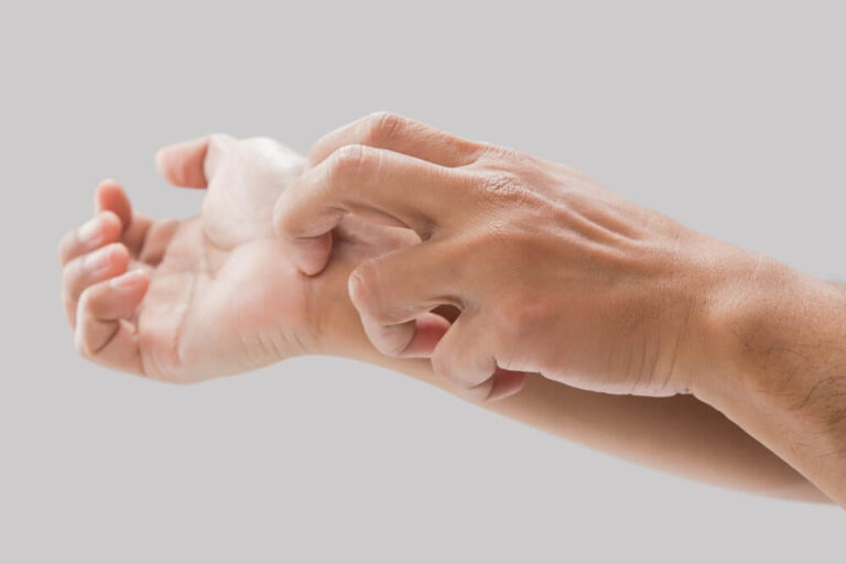What Are Hives And Symptoms Of Hives Allergy And Immunology Center
