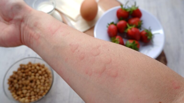 What are hives and symptoms of hives | Allergy & Immunology Center