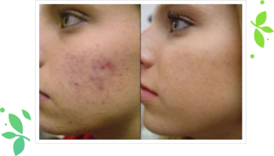 Best Acne Treatment in Deerfield Beach, FL | Green Dermatology