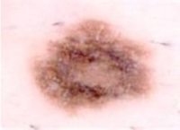 Dysplastic Nevus Treatment in Deerfield Beach, FL | Green Dermatology