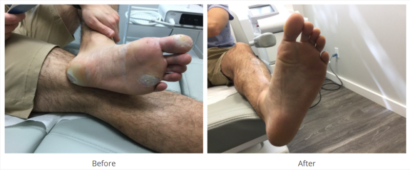 Warts Treatment in Deerfield Beach, FL | Green Dermatology