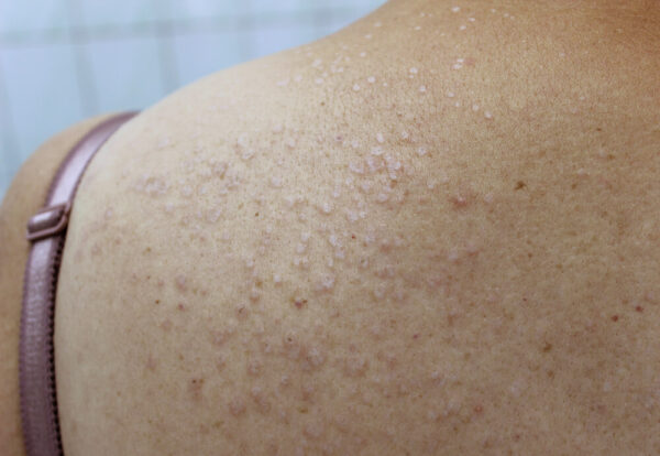 What is Lichen Sclerosis | My ObGyn Specialists