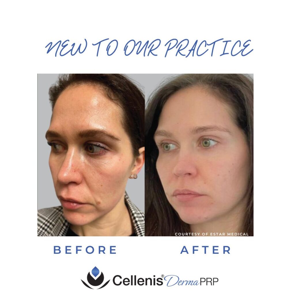 PRP Filler | Stern Comprehensive Women's Healthcare